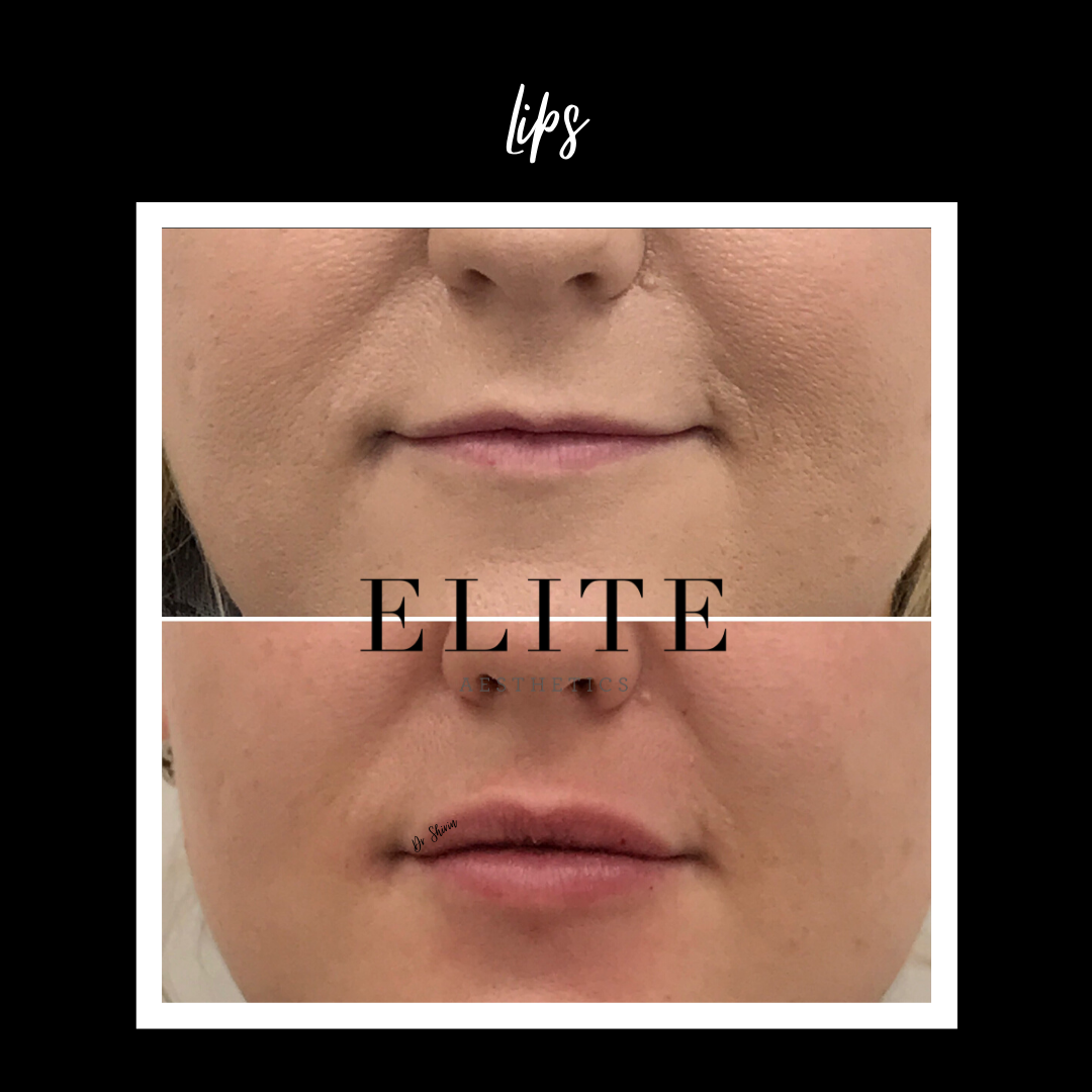 Fillers For The Lips Before After FAQs Cost Fillers For The Lips Before After FAQs Cost