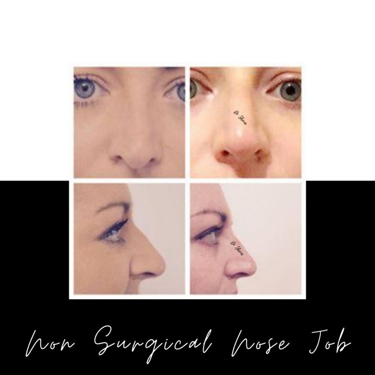 Non Surgical Nose Job Before and After - Results from a Qualified Doctor