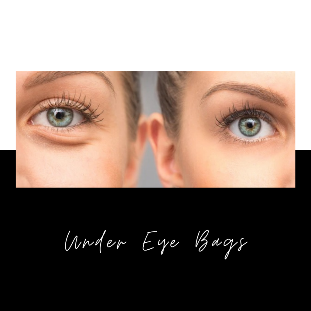 Bags Under Eyes? Causes, Treatments and Solutions