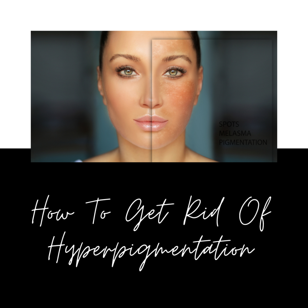 Get Rid Of Hyperpigmentation | Elite Aesthetics