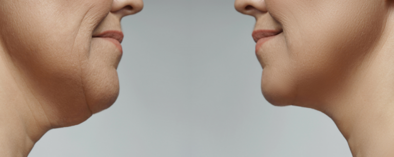 Neck Threads: The Saggy Neck Solution?