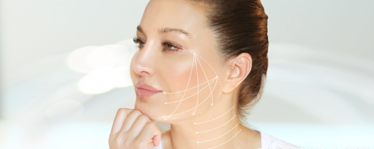 Face Thread Lift Before & After