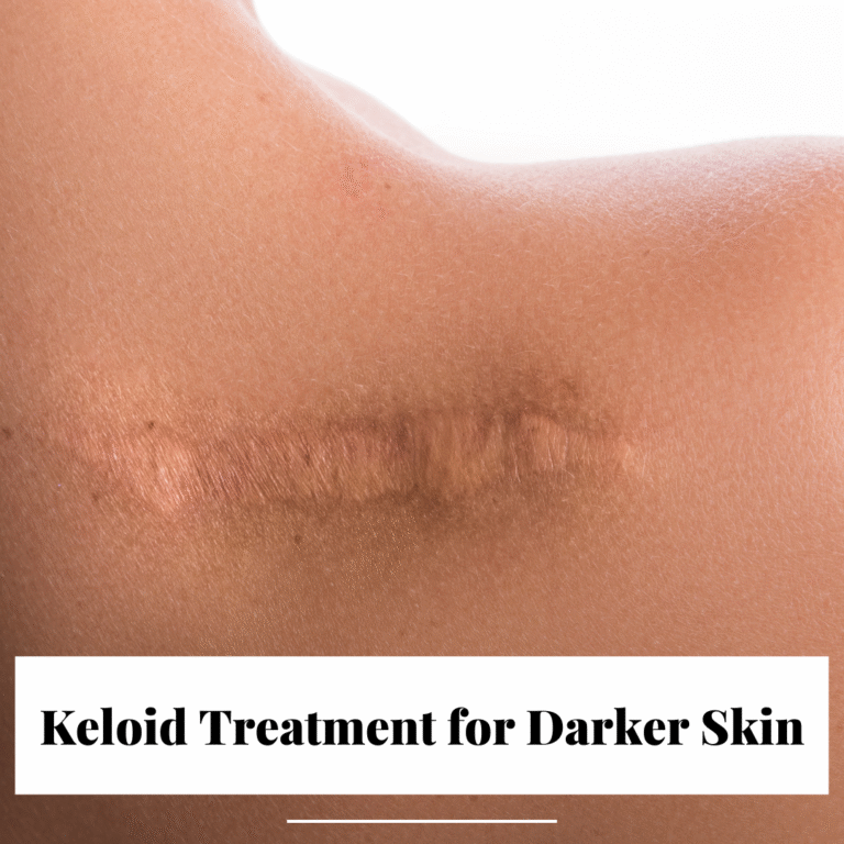 Scarring and Keloid Treatment for Darker Skin Types | Elite Aesthetics Kent