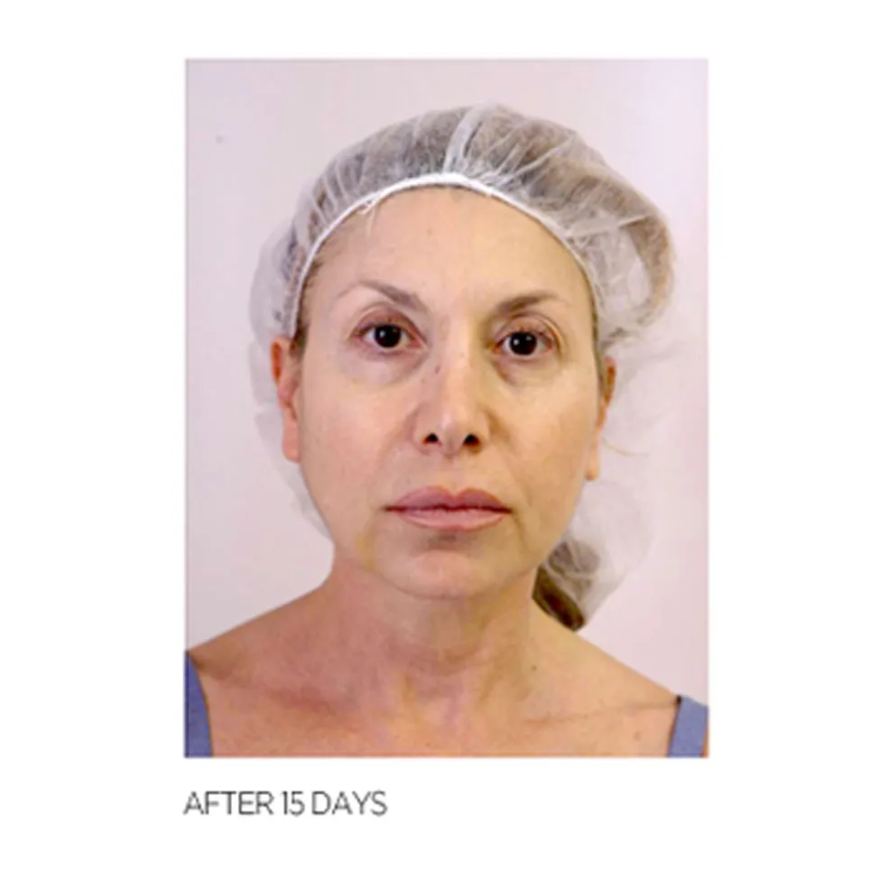 Thread Face Lift: What to Expect, Cost, Recovery, and More