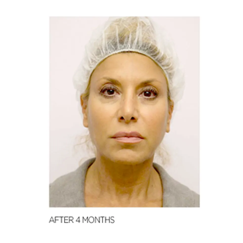 Thread Face Lift: What to Expect, Cost, Recovery, and More