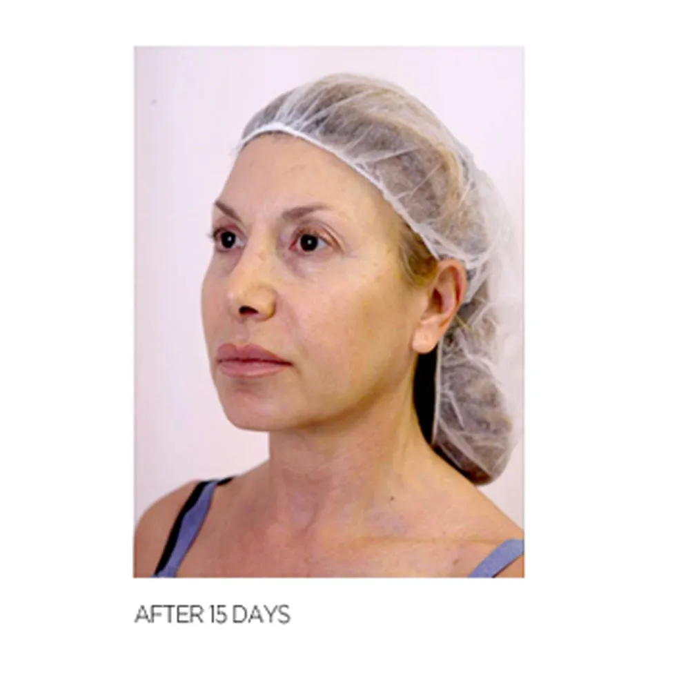 Thread Face Lift: What to Expect, Cost, Recovery, and More